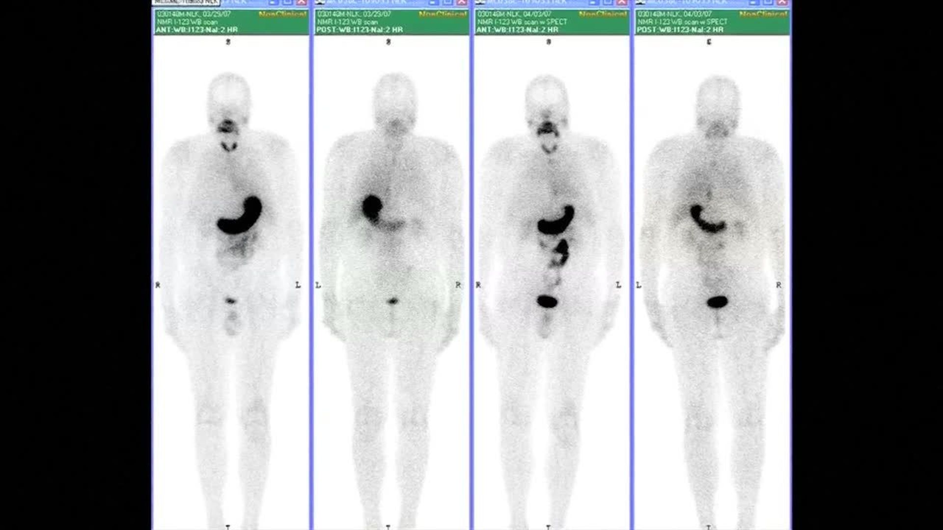 Watch La storia del tumore ucciso dal virus del morbillo | Wired Italia